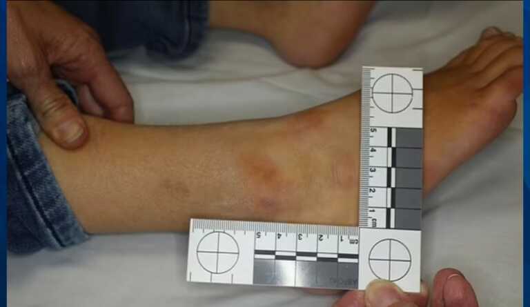 WARNING GRAPHIC IMAGES: Horrific Injuries of Ruby Franke’s Abused ...